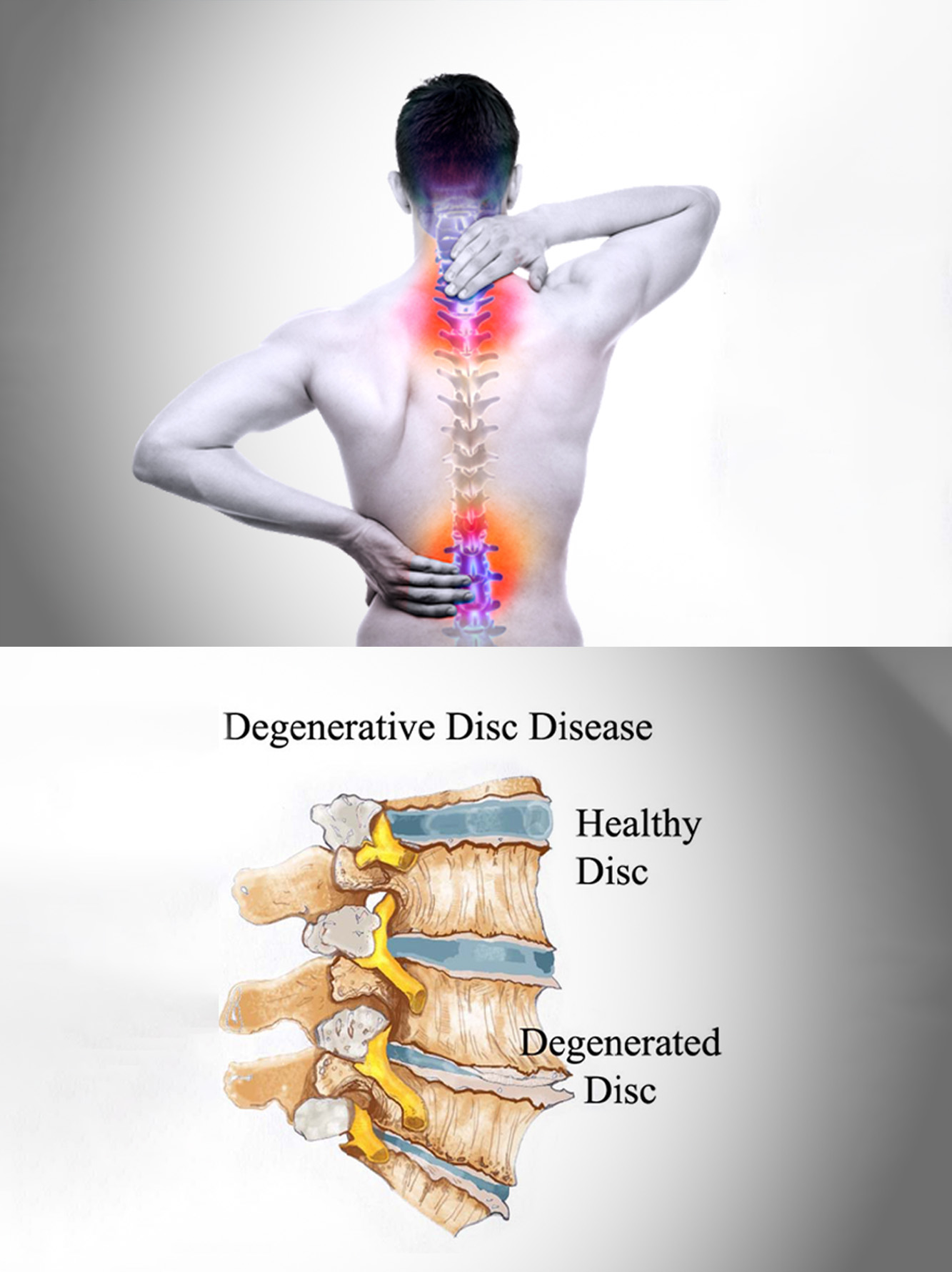 Degenerative Disc Disease - Abhayamritham