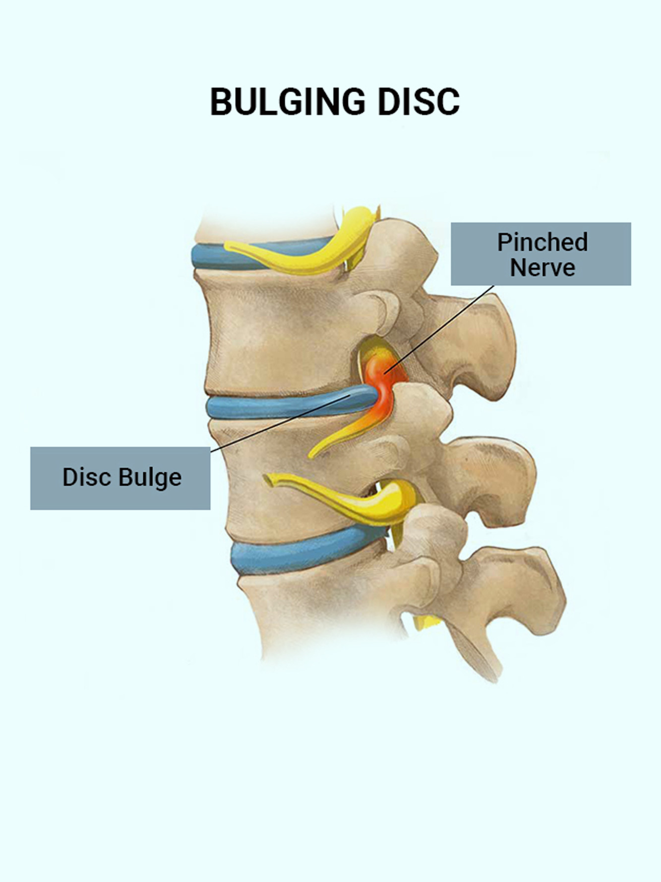 Disc Bulge – Abhayamritham