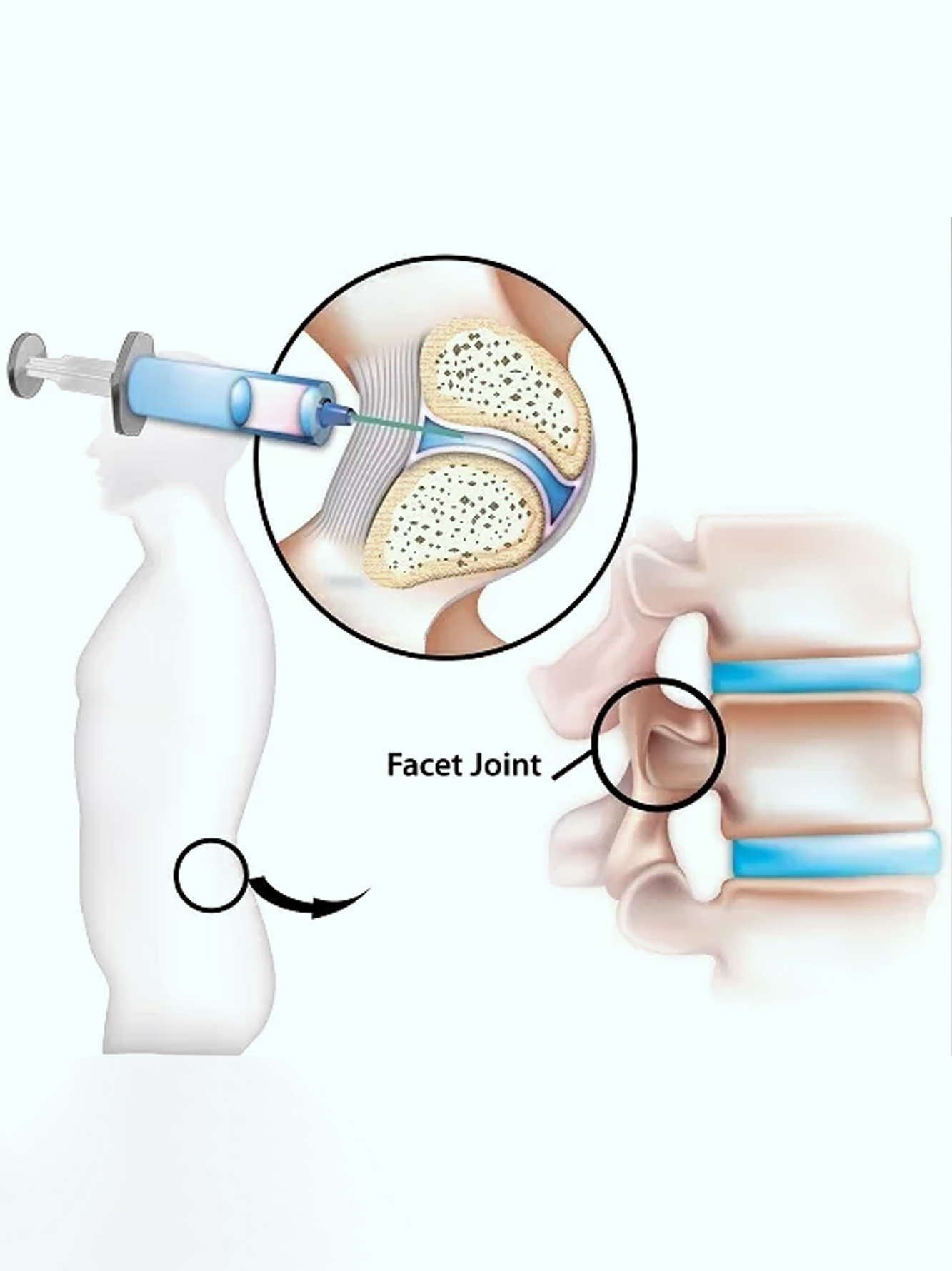 Facet Joint Arthropathy - Abhayamritham
